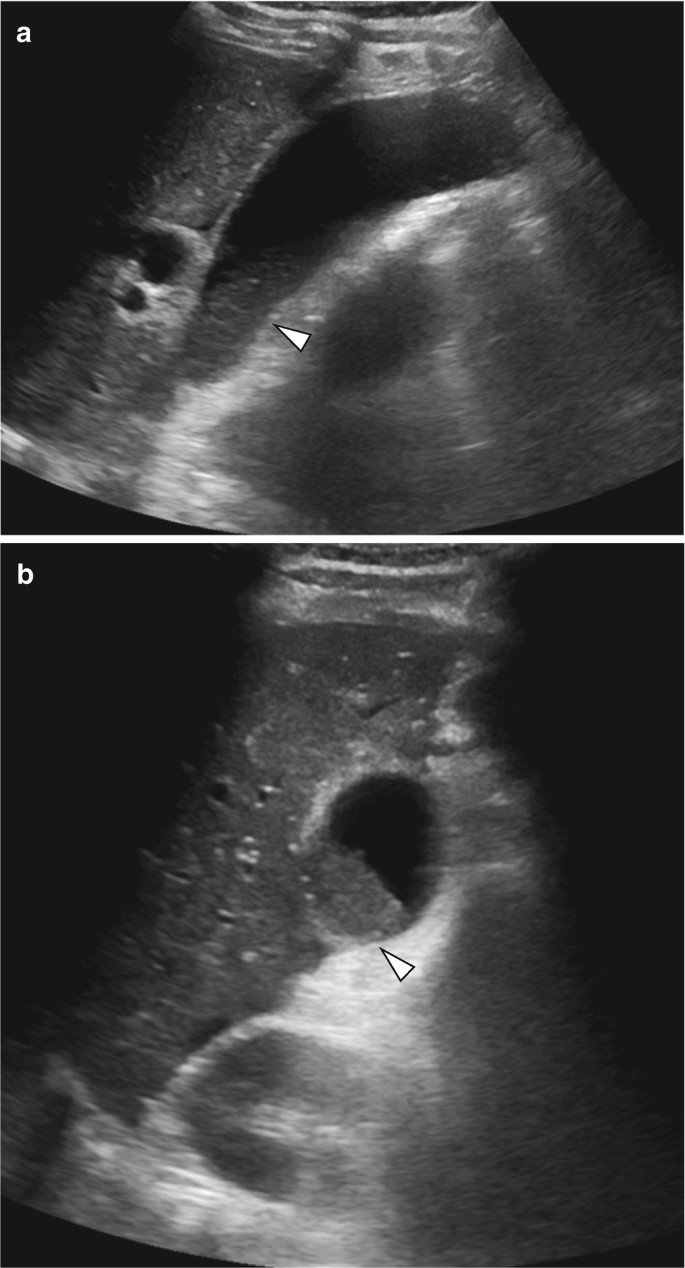 Gallbladder and Biliary Tract | SpringerLink