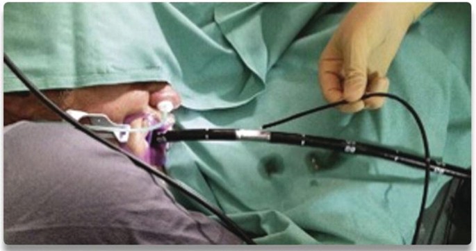 Choledochoscopy: Techniques and Innovation | SpringerLink