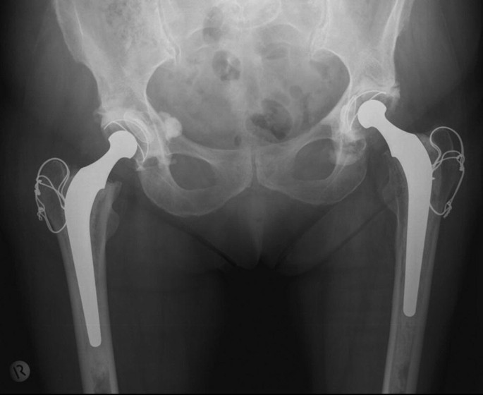 Postoperative Hip | Springer Nature Link