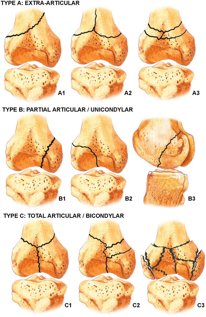 Acute Osseous Injury to the Knee | Springer Nature Link