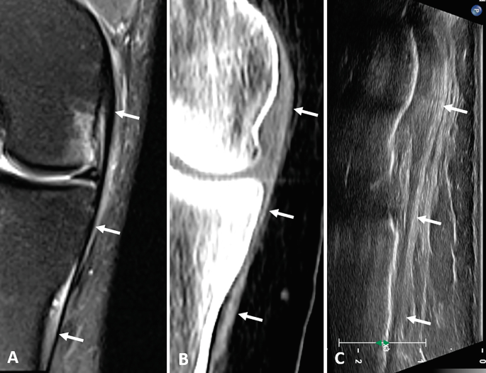 Internal Derangement of the Knee: Ligament Injuries | SpringerLink