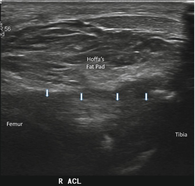 Internal Derangement of the Knee: Ligament Injuries | SpringerLink