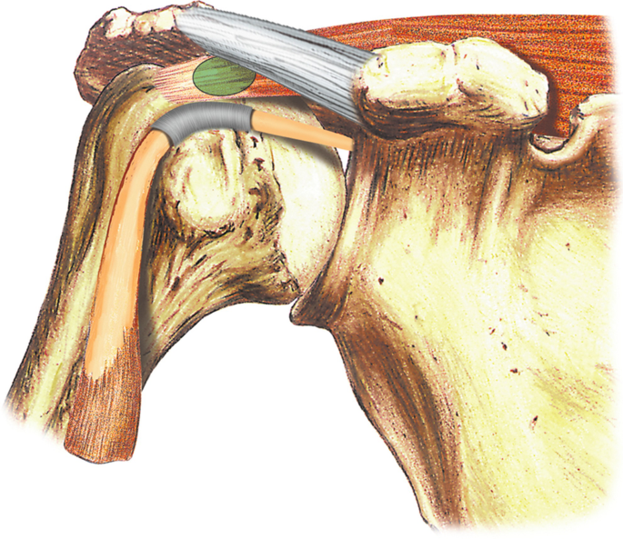 The Rotator Cuff and Shoulder Impingement Syndromes | Springer Nature Link