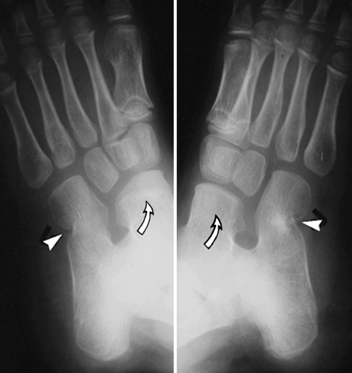 Anteater Nose Sign Foot