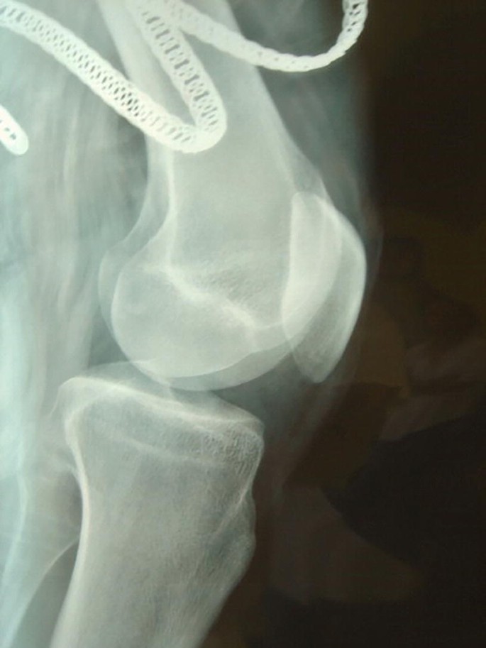 Acute Patellar Dislocation | Springer Nature Link