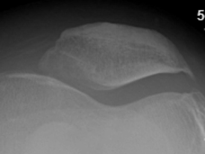 Isolated Patellofemoral Arthritis | SpringerLink