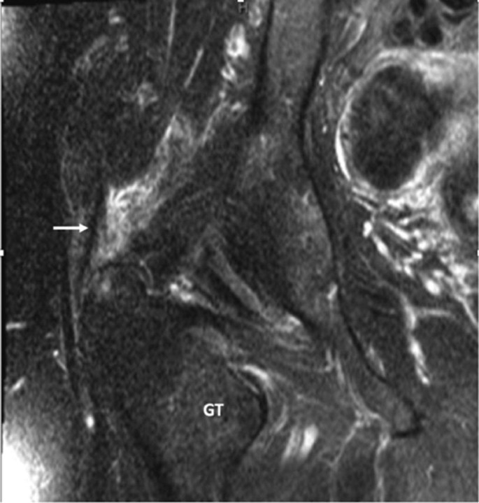 Greater Trochanteric Pain Syndrome: Gluteal Tendinopathy, Partial Tear ...