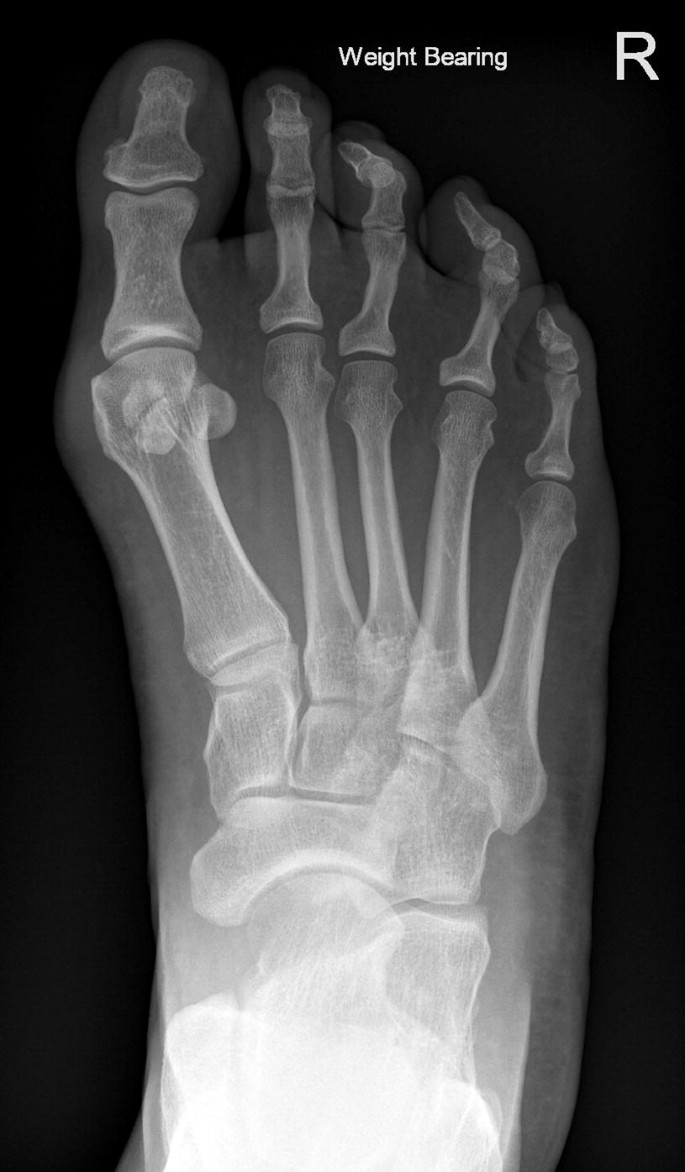 Hallux Sesamoid Stress Fractures | SpringerLink