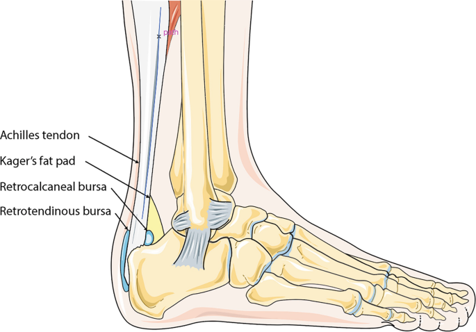 Insertional Achilles Tendinopathy and Retrocalcaneal Bursitis ...