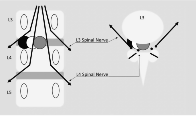 Lumbar Disc Herniation and Spinal Stenosis | SpringerLink