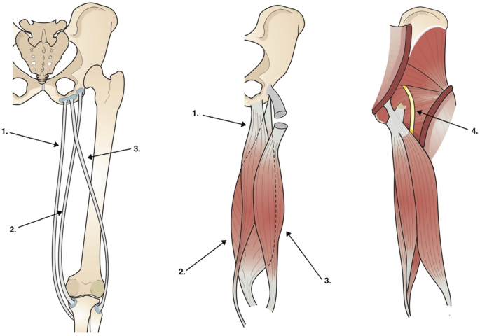 Proximal Hamstring Avulsion | SpringerLink