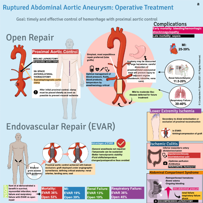 Abdominal Aortic Aneurysm Rupture