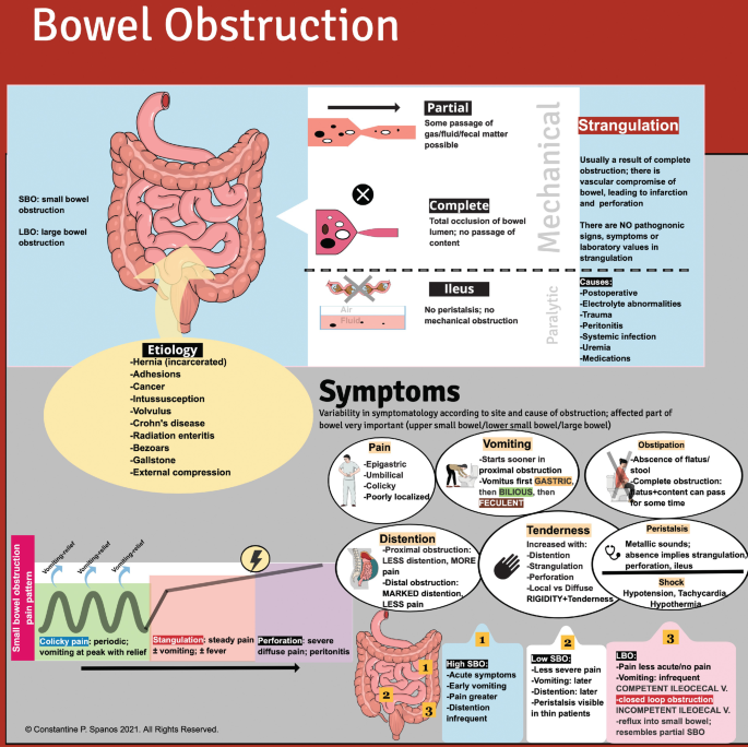 Small Bowel Obstruction (SBO) | SpringerLink