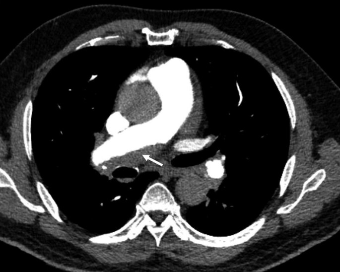 Follow-Up of Right Ventricular Function After Acute Pulmonary Embolism ...