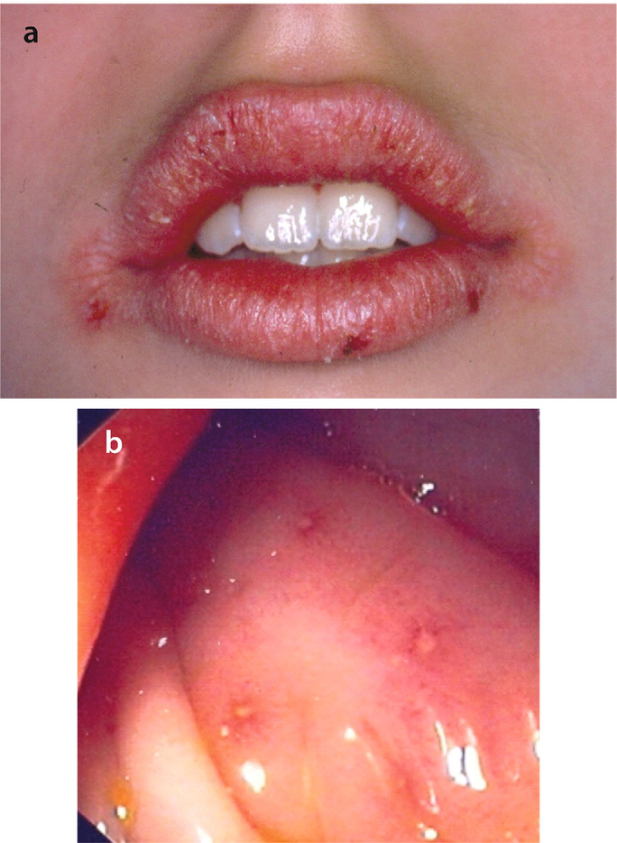 Oral Lesions in Children and Adolescents | Springer Nature Link ...