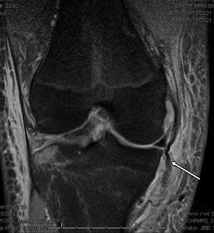 Anterior Cruciate Ligament Concomitant Injuries and Rotatory Knee ...