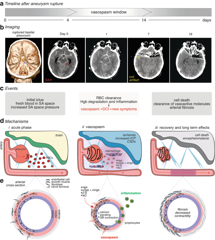 Cerebral Vasospasm | SpringerLink