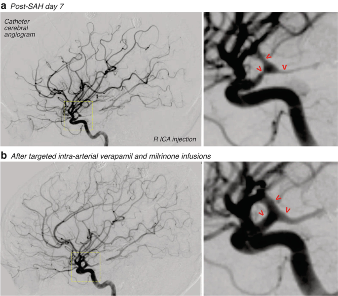 Cerebral Vasospasm | SpringerLink