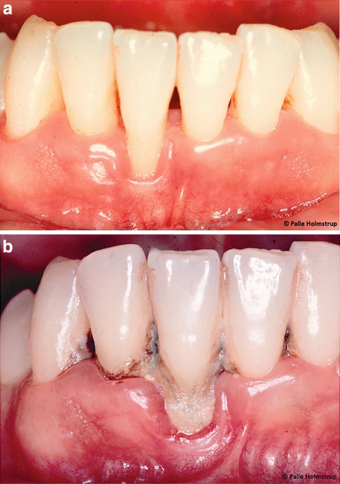 Cardiovascular Diseases and Periodontitis | SpringerLink