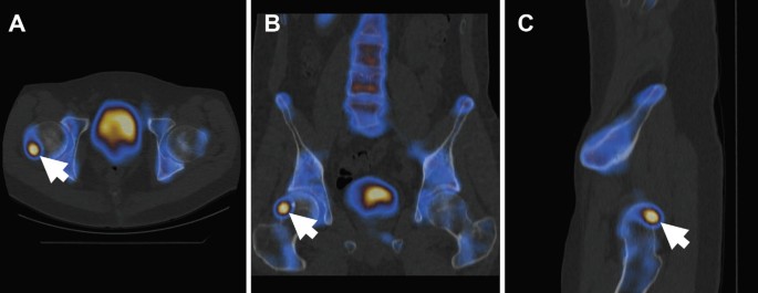 Femoroacetabular Impingement (FAI) Syndrome | SpringerLink