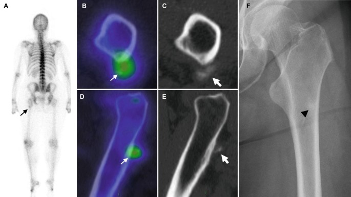Calcific Tendonitis | SpringerLink