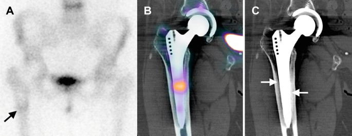 Hip Arthroplasty: Assessment of Component Position and Fixation ...