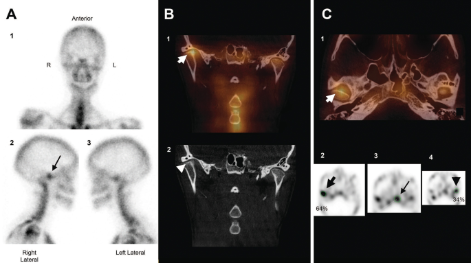 SPECT/CT in Condylar Hyperplasia | Springer Nature Link