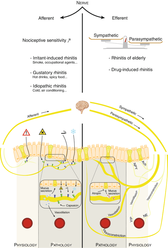 Non-allergic Rhinitis | SpringerLink