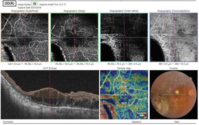 Radiation Retinopathy | SpringerLink