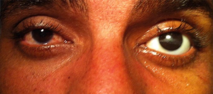 Sympathetic Ophthalmia | SpringerLink