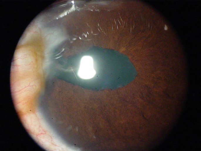 Sympathetic Ophthalmia | Springer Nature Link (formerly SpringerLink)