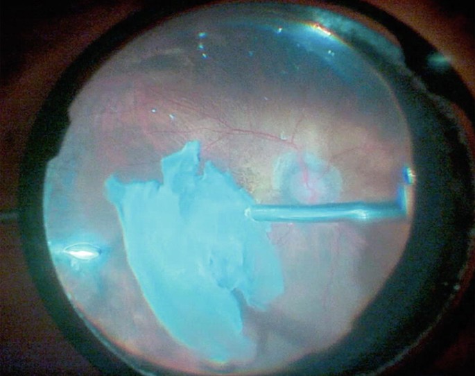 Posterior Lensectomy | SpringerLink