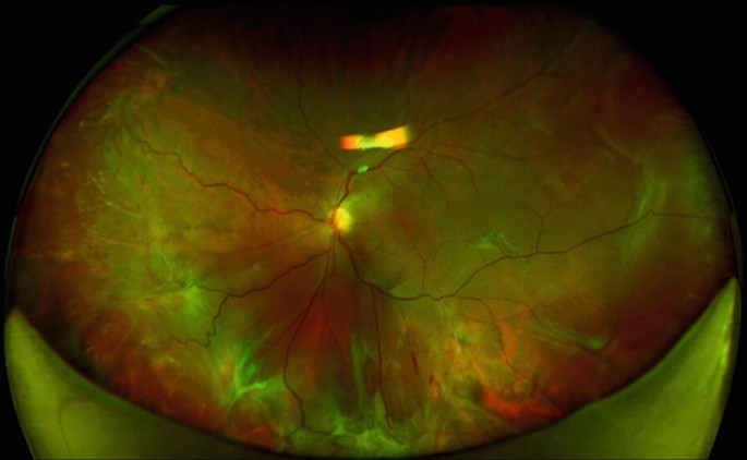 Proliferative Vitreoretinopathy | SpringerLink