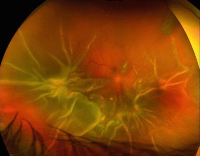 Proliferative Vitreoretinopathy | SpringerLink