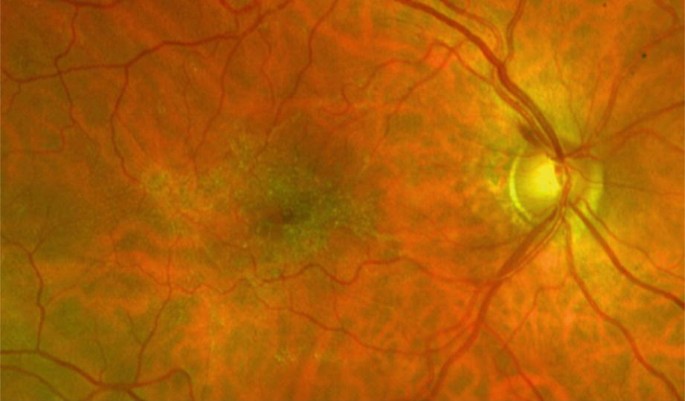 Epiretinal Membrane | SpringerLink