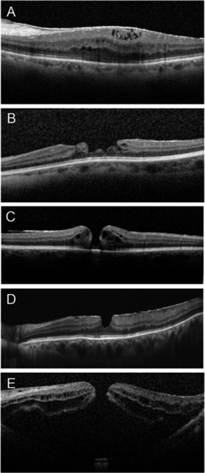 Epiretinal Membrane | SpringerLink