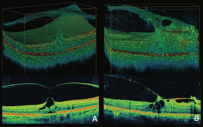 Vitreomacular Traction Syndrome | SpringerLink