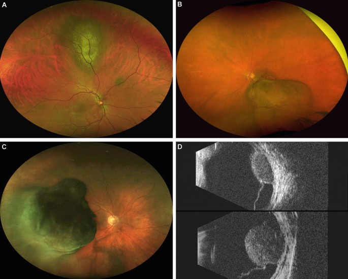 Choroidal Melanoma | SpringerLink