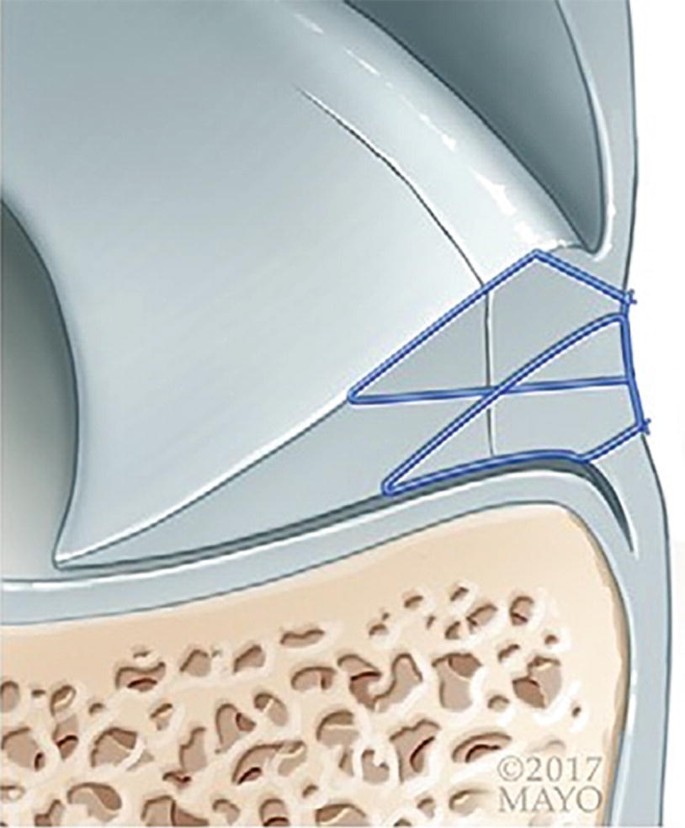 Inside-Out Arthroscopic Meniscus Repair Techniques | SpringerLink
