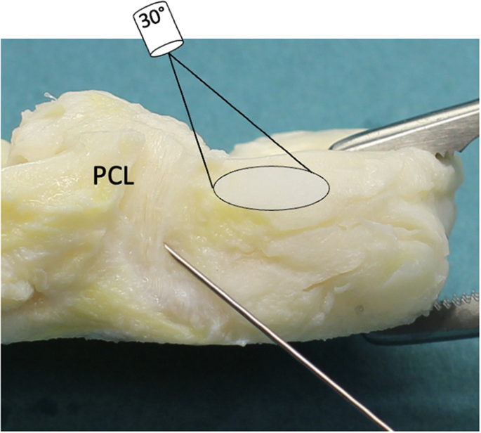 Arthroscopic Meniscal Ramp Tear Repair | SpringerLink