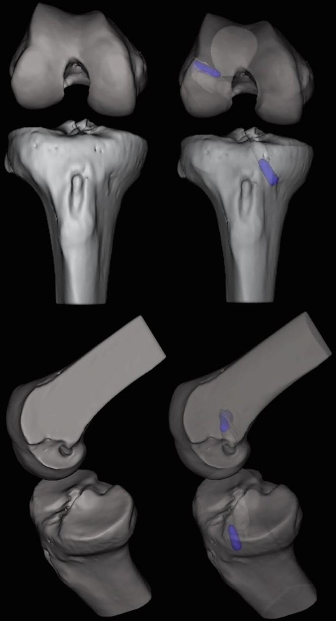 Revision Anterior Cruciate Ligament Reconstruction | SpringerLink