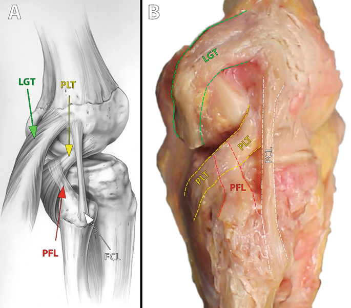 Posterior Lateral Corner Injury