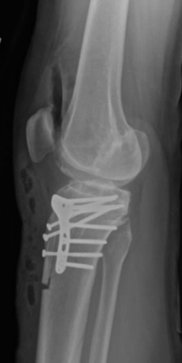 Proximal Tibial Osteotomy and Revision ACL Reconstruction | Springer ...