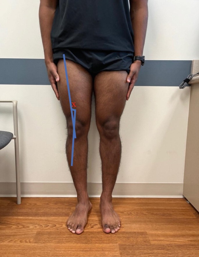 Physical Examination and Imaging Specific to the Extensor Mechanism ...