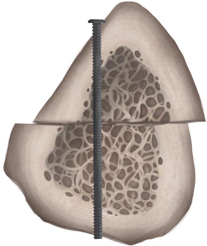 Tibial Tuberosity Anatomy and Surgery | SpringerLink