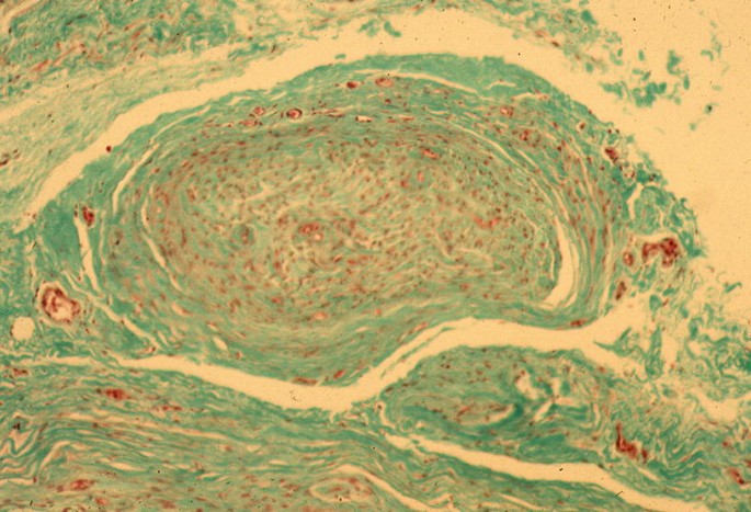 Surgical Approach to Patellofemoral Pain | SpringerLink