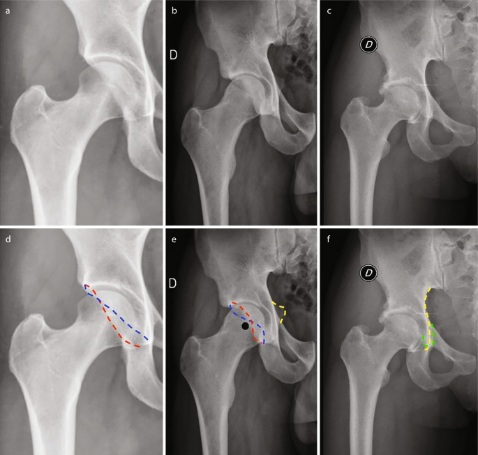 Pincer-Type Femoroacetabular Impingement (FAI) | SpringerLink