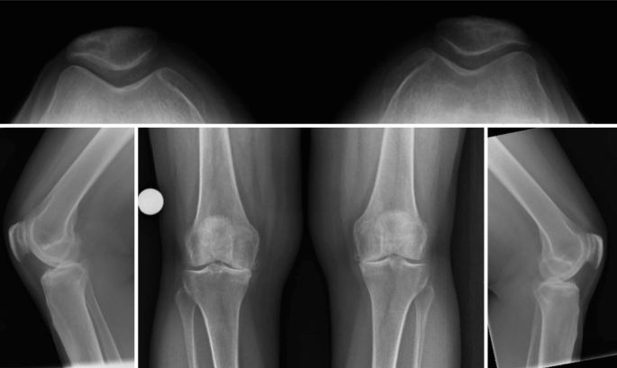 Partial Knee Replacements | SpringerLink