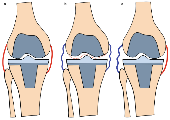 TKA Instability | Springer Nature Link