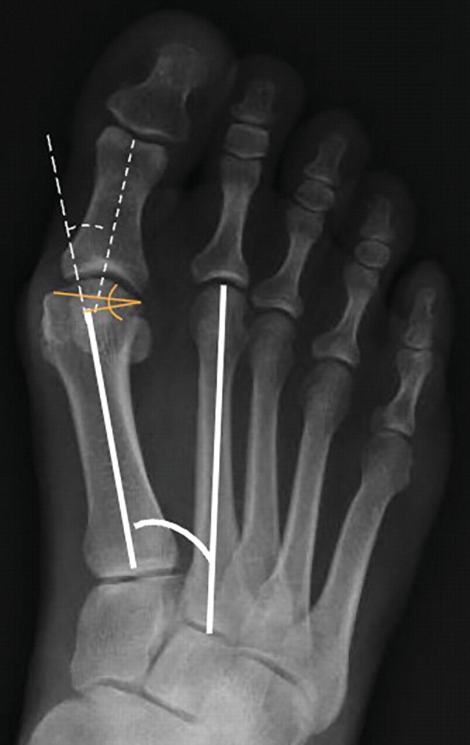 Hallux Deformities | SpringerLink